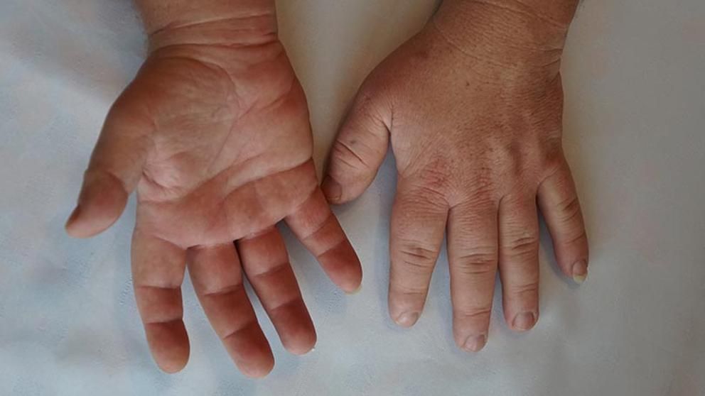 Fisioterapia para enfermedades raras: ACROMEGALIA | FisioStar