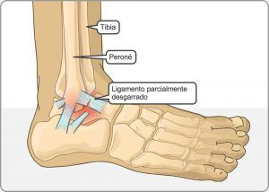 Consejos para el tratamiento de ESGUINCE DE TOBILLO con fisioterapia ...